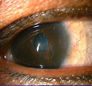Eye Trauma: Initial Care