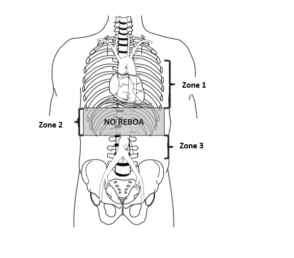 Resuscitative Endovascular Balloon Occlusion of the Aorta (REBOA) for ...