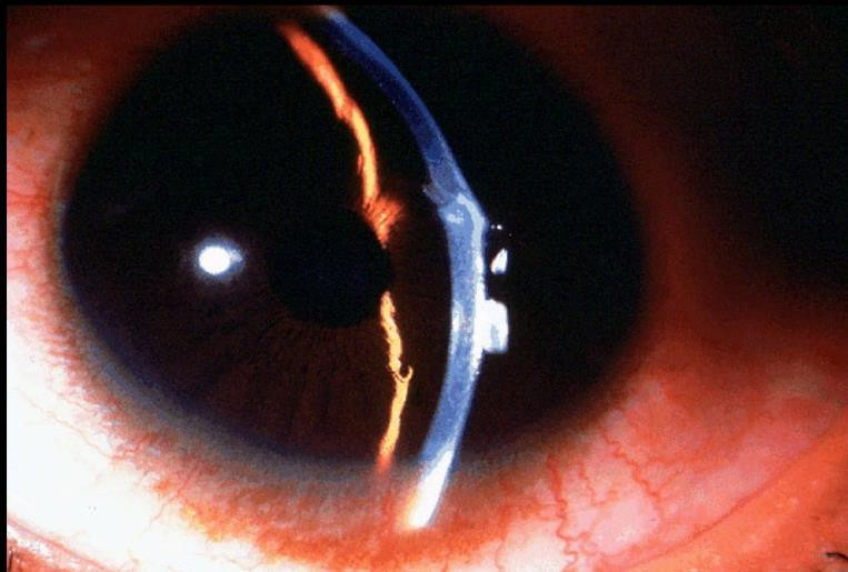 Eye Trauma: Initial Care